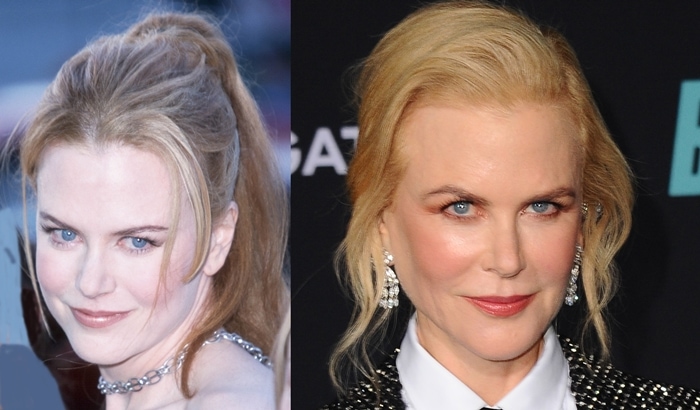 Nicole Kidman's Plastic Surgery Regret: See Her Frozen Face Before and After