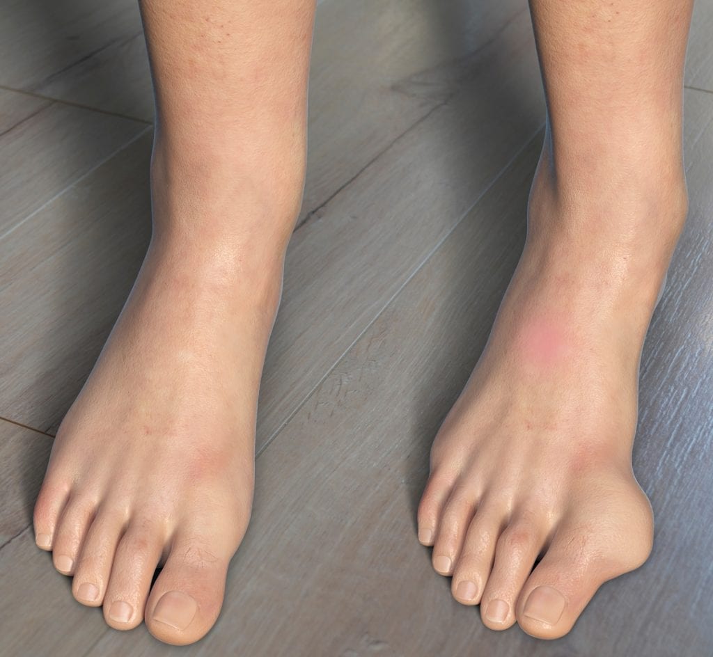 Painful Yet Stylish: Celebrities Who Battle Bunions in High Heels